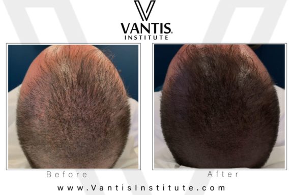 Hair Restoration | Follicle Replication | Vantis Institute Vantis Institute