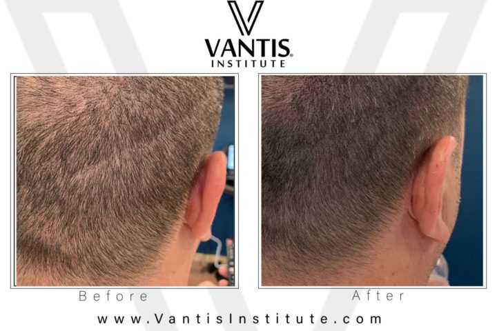 Hair Restoration | Follicle Replication | Vantis Institute Vantis Institute